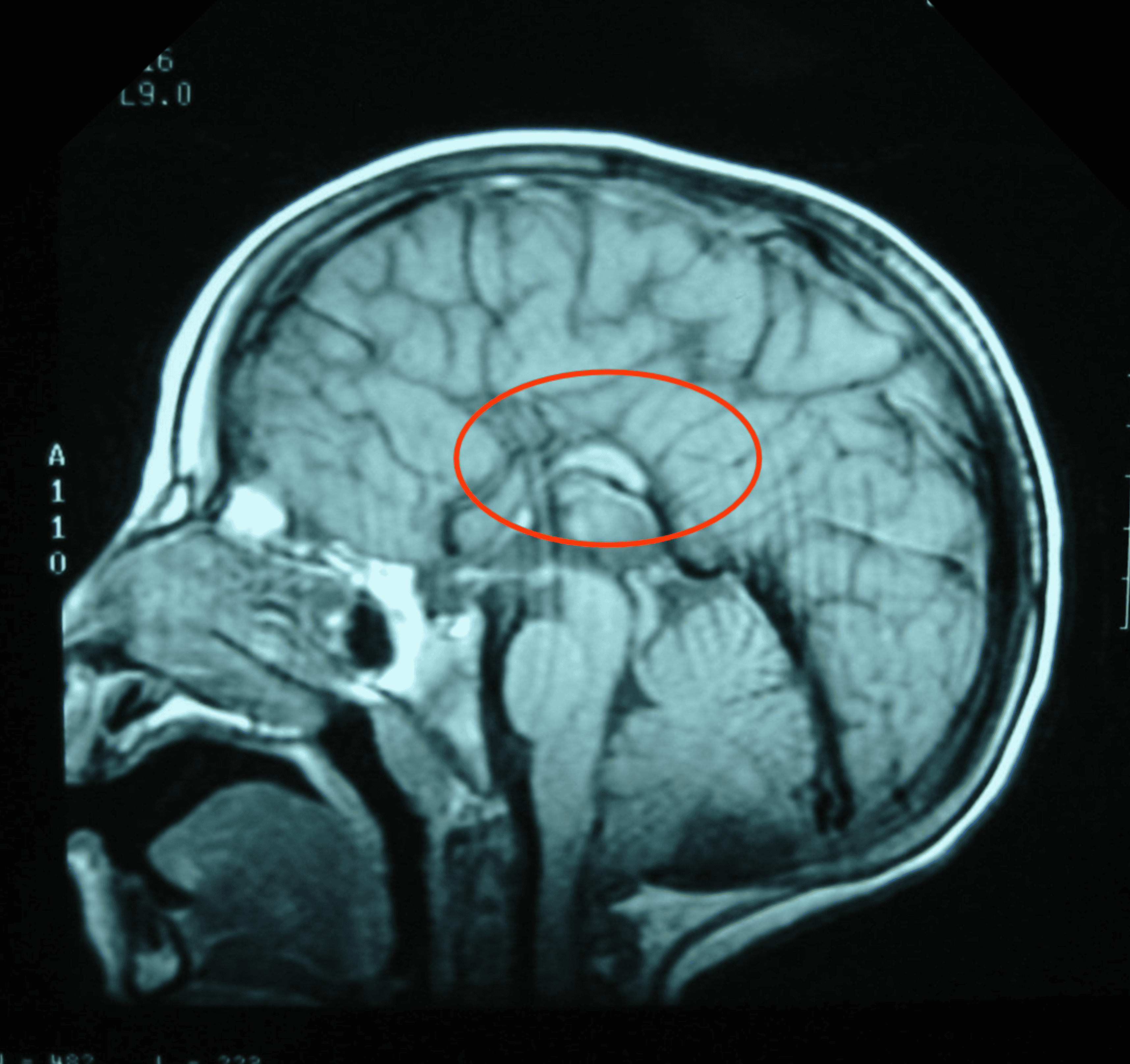 Partial Agenesis of the Corpus Callosum - NODCC