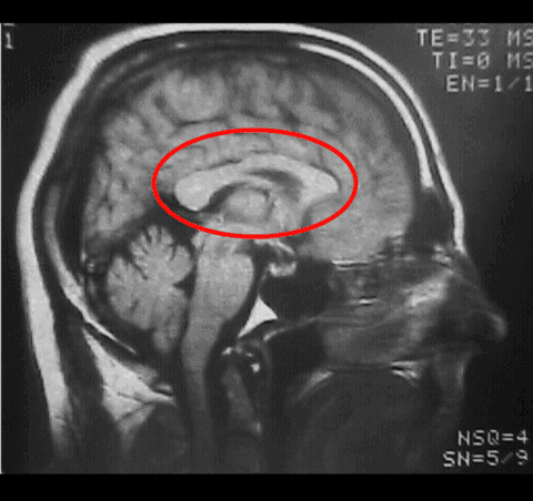 Agenesis of the Corpus Callosum - NODCC
